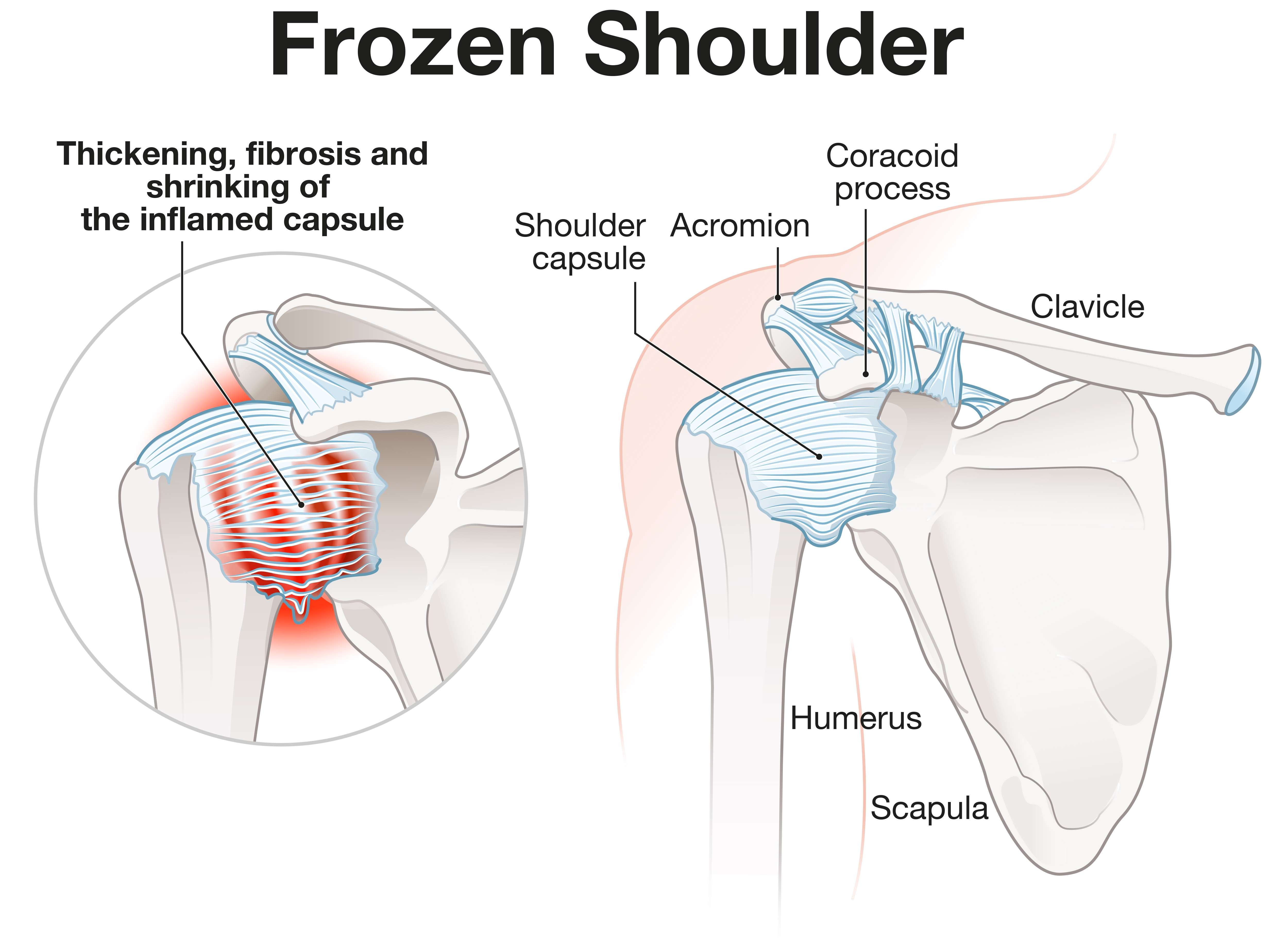 Frozen Shoulder